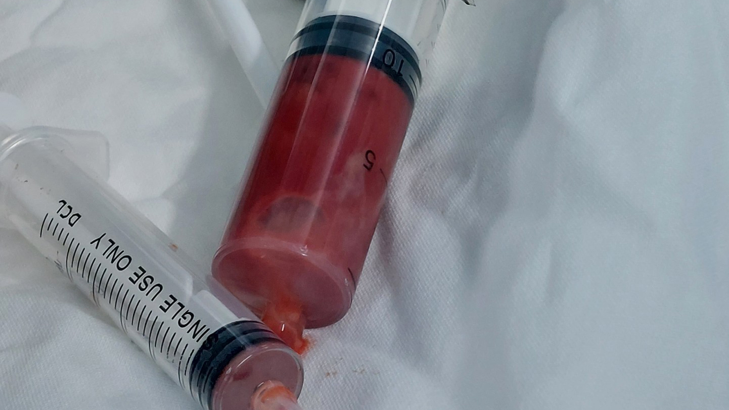 PHẪU THUẬT THÀNH CÔNG TRƯỜNG HỢP HIẾM GẶP: ÁP XE TỤY DO XƯƠNG CÁ - Bệnh ...